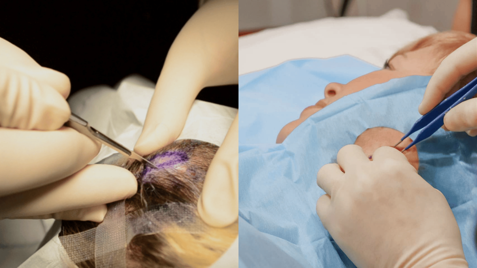 Pilar Cyst vs Sebaceous Cyst: Key Differences - Obviousmag