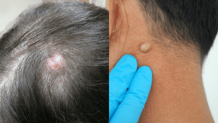 Pilar Cyst vs Sebaceous Cyst: Key Differences - Obviousmag