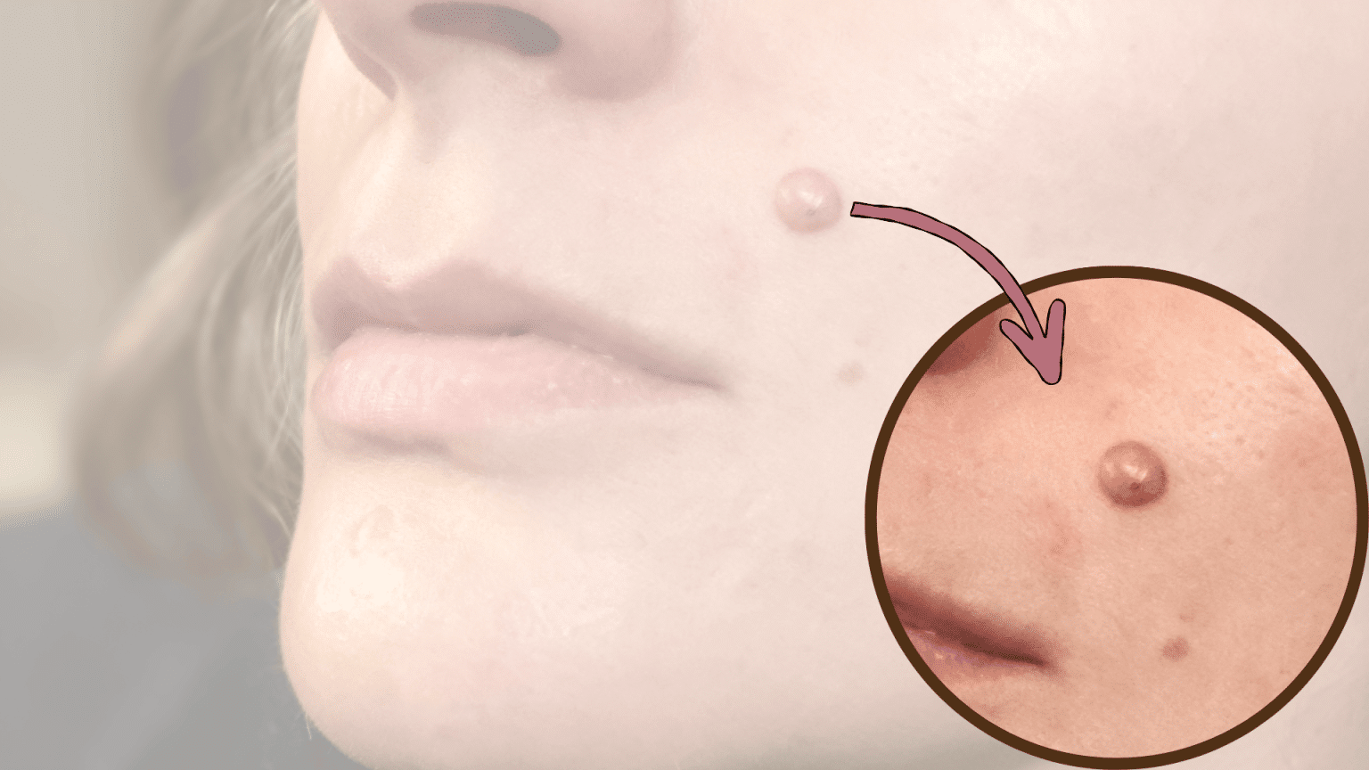 How to Remove Beauty Marks Safely? - Obviousmag